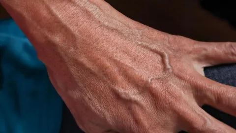 If You See Someone With Bulging Veins, You Must Tell Them These 5 ...